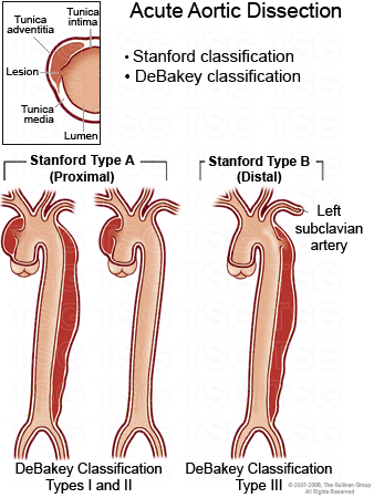 Acute Aortic Dissection - Quick Consult